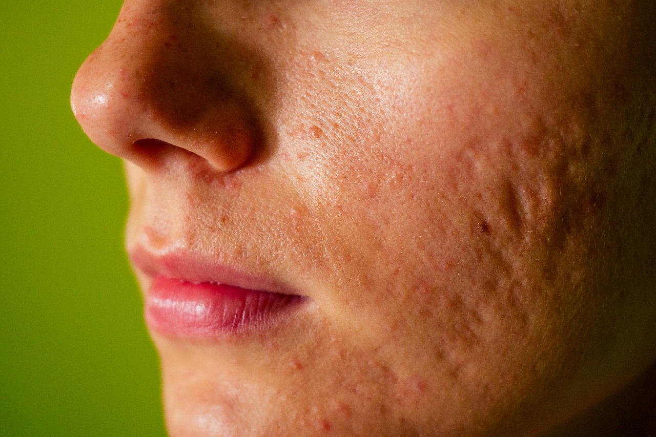 Skin Xperts – Super Speciality Skin, Hair & Laser Clinic