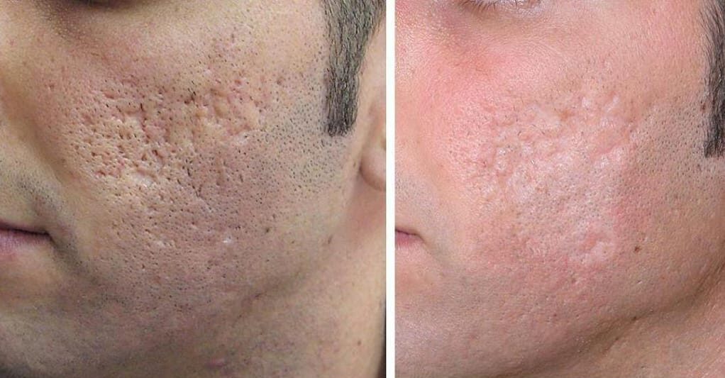 Laser Treatment for Ance Scar and Acne – Skin Xperts