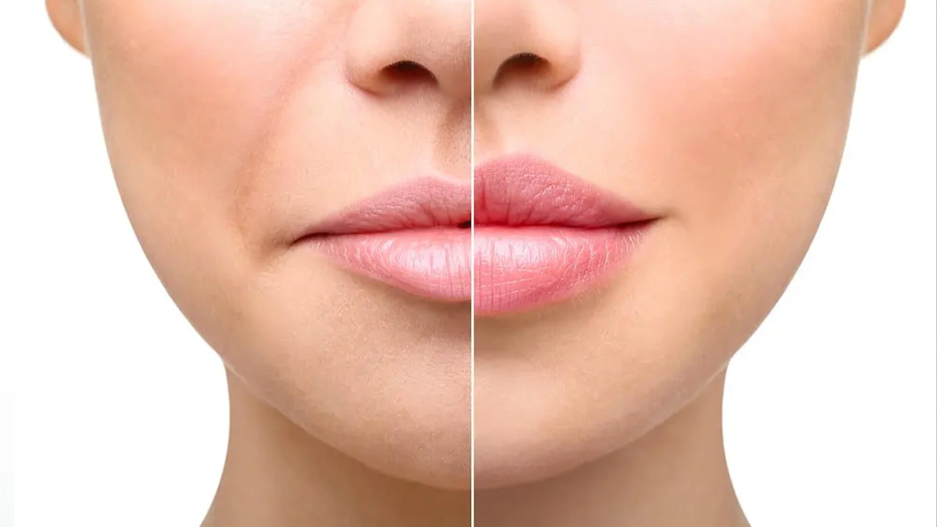 Lip Augmentation Surgery – Skin Xperts